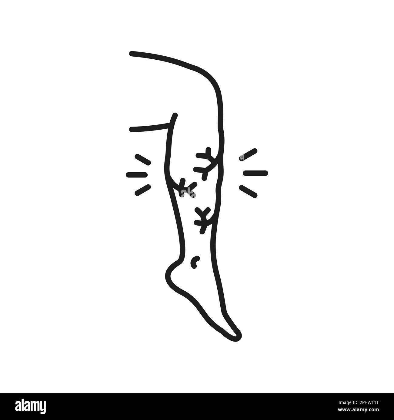 Veine variqueuse, maillage vasculaire sur les jambes. Vecteur icon ...