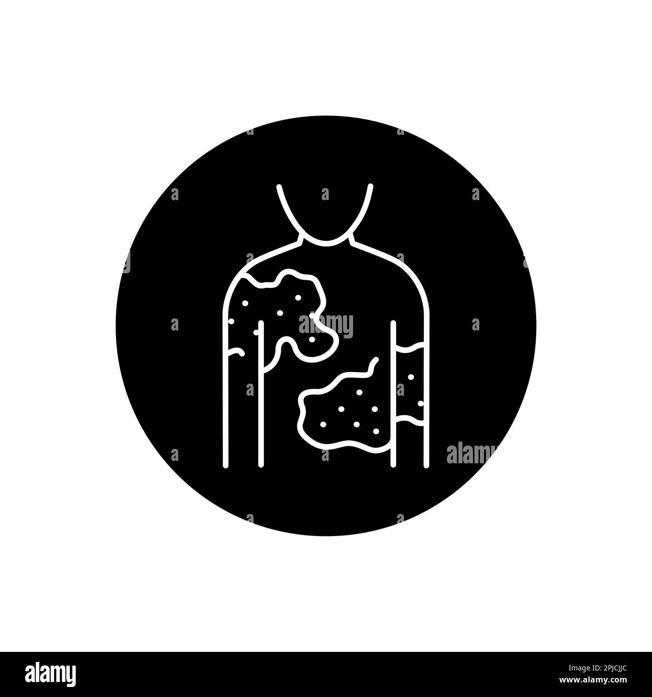 Urticaire chronique Banque d'images vectorielles - Alamy