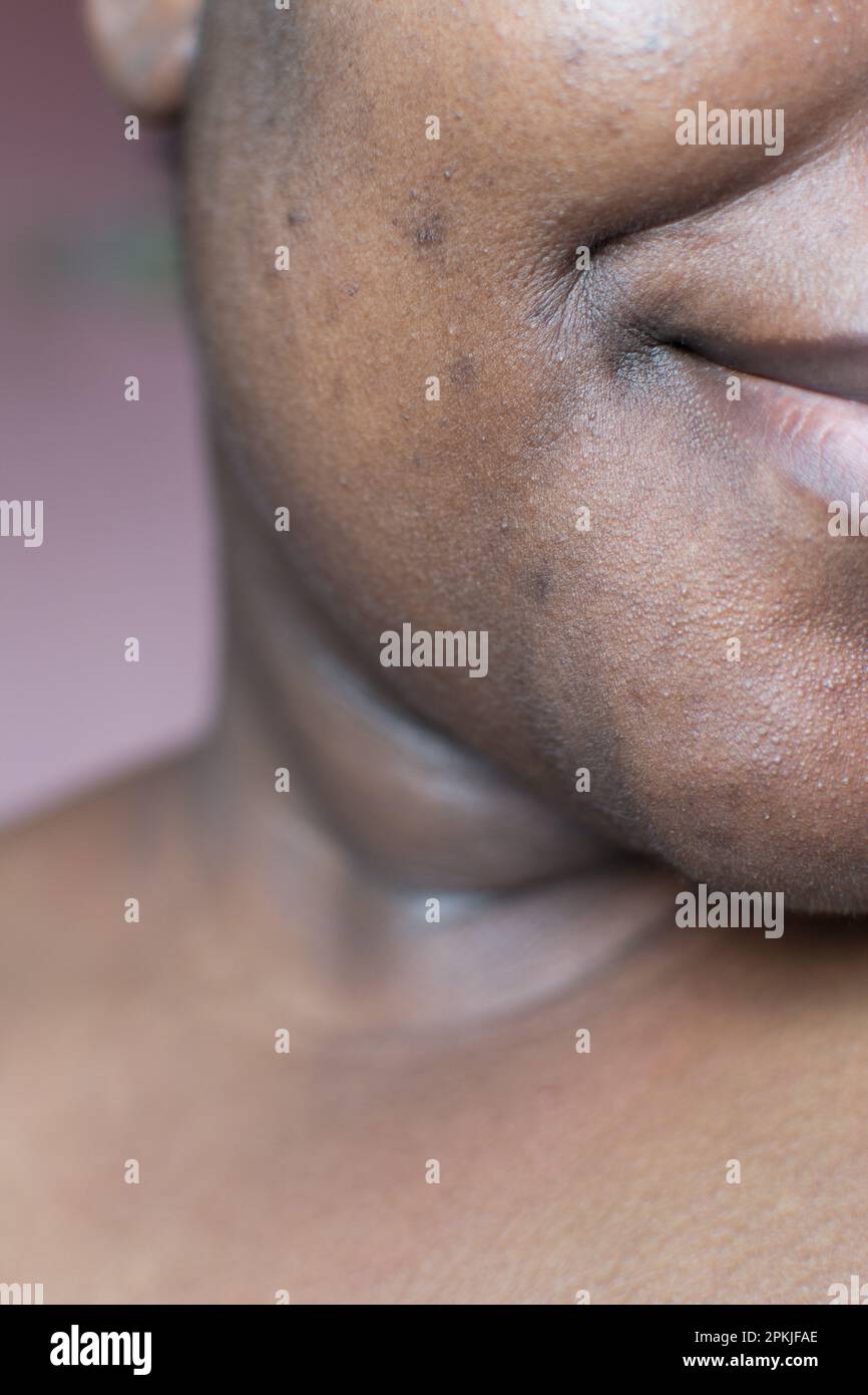 Pigmentation de la peau Banque de photographies et d’images à haute ...