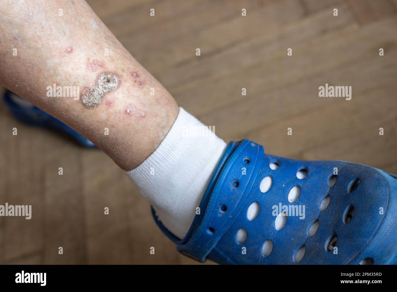 Ulcères et maladies de la peau, croûtes séchées et blessures fraîches ...