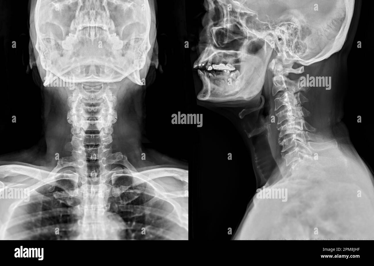 Radiographie du rachis cervical ou image radiographique du rachis ...