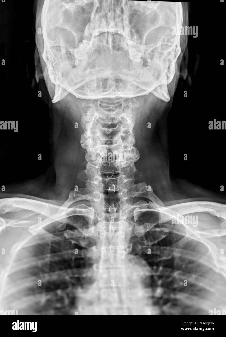 Radiographie du rachis cervical ou radiographie de la colonne cervicale ...