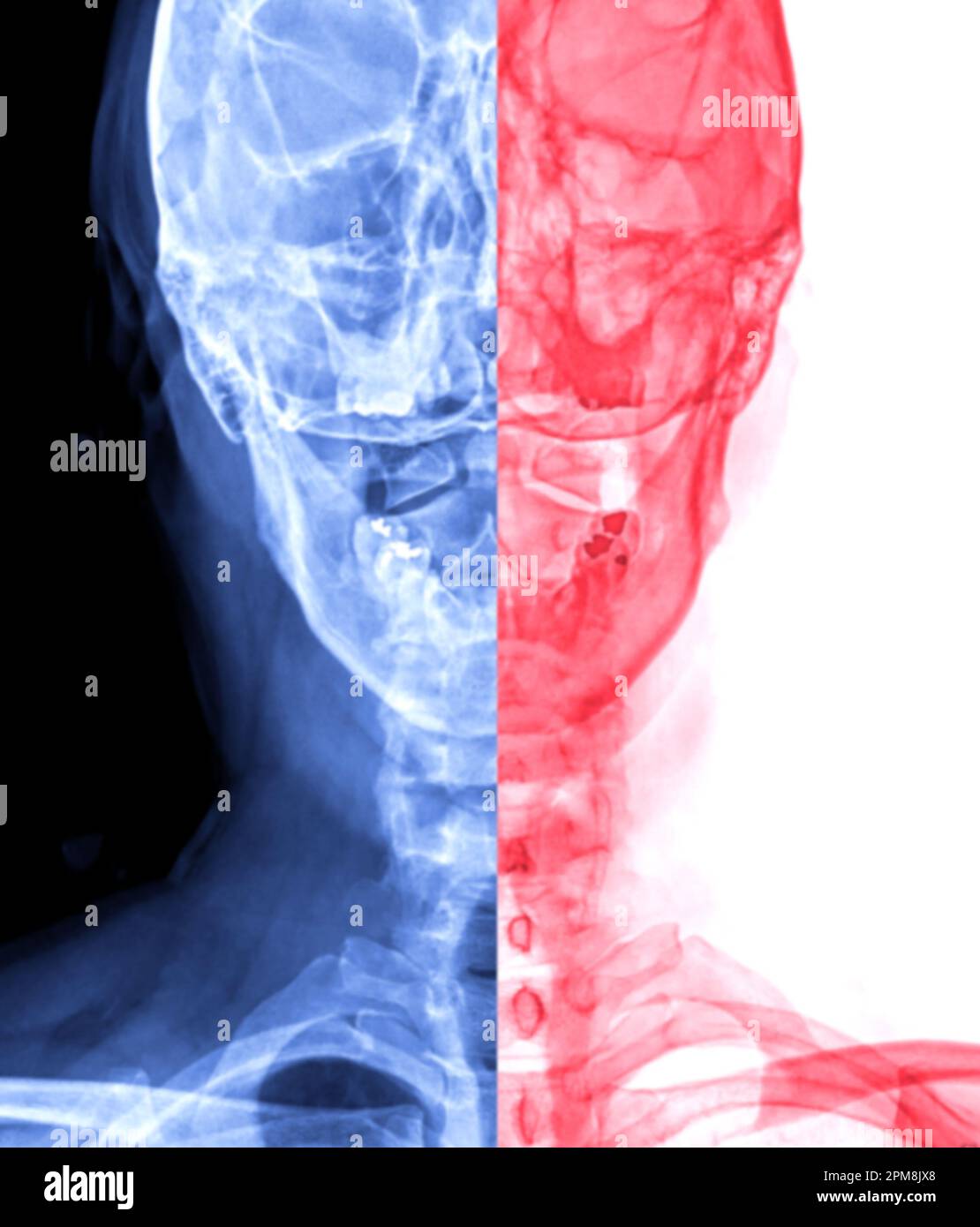 Radiographie du rachis cervical ou image radiographique du rachis ...