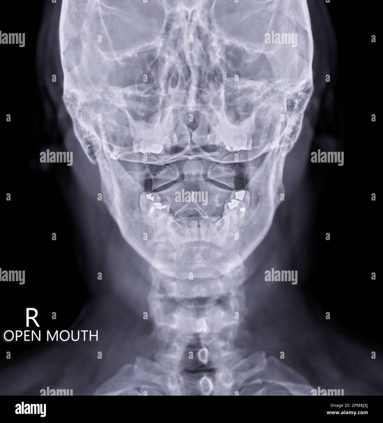 Radiographie du rachis cervical ou image radiographique du rachis ...