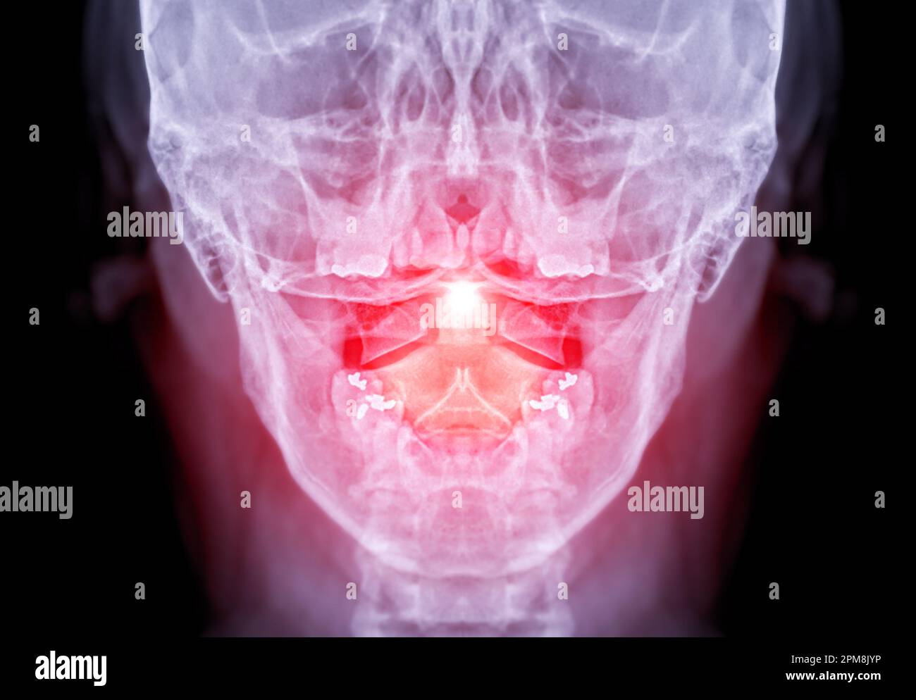 Radiographie du rachis cervical ou image radiographique du rachis ...