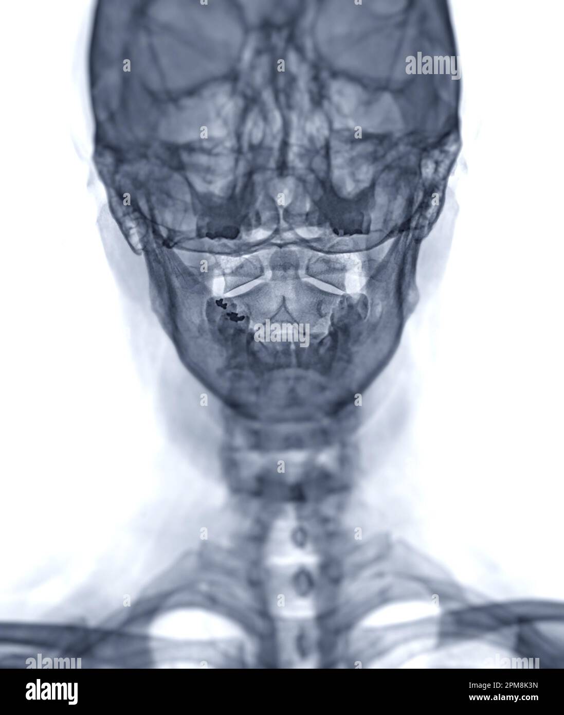 Radiographie du rachis cervical ou image radiographique du rachis ...