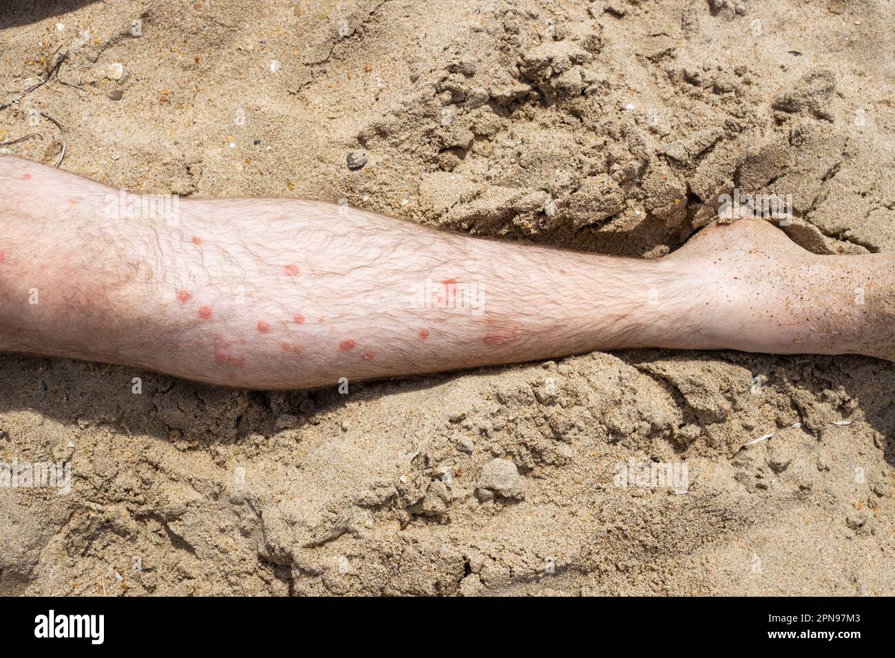 Irruption allergique sur la jambe Banque de photographies et d’images à ...