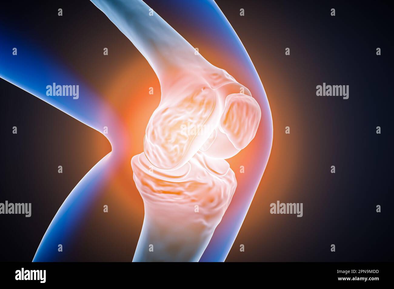 Articulation du genou humain et os avec inflammation, blessure ou ...