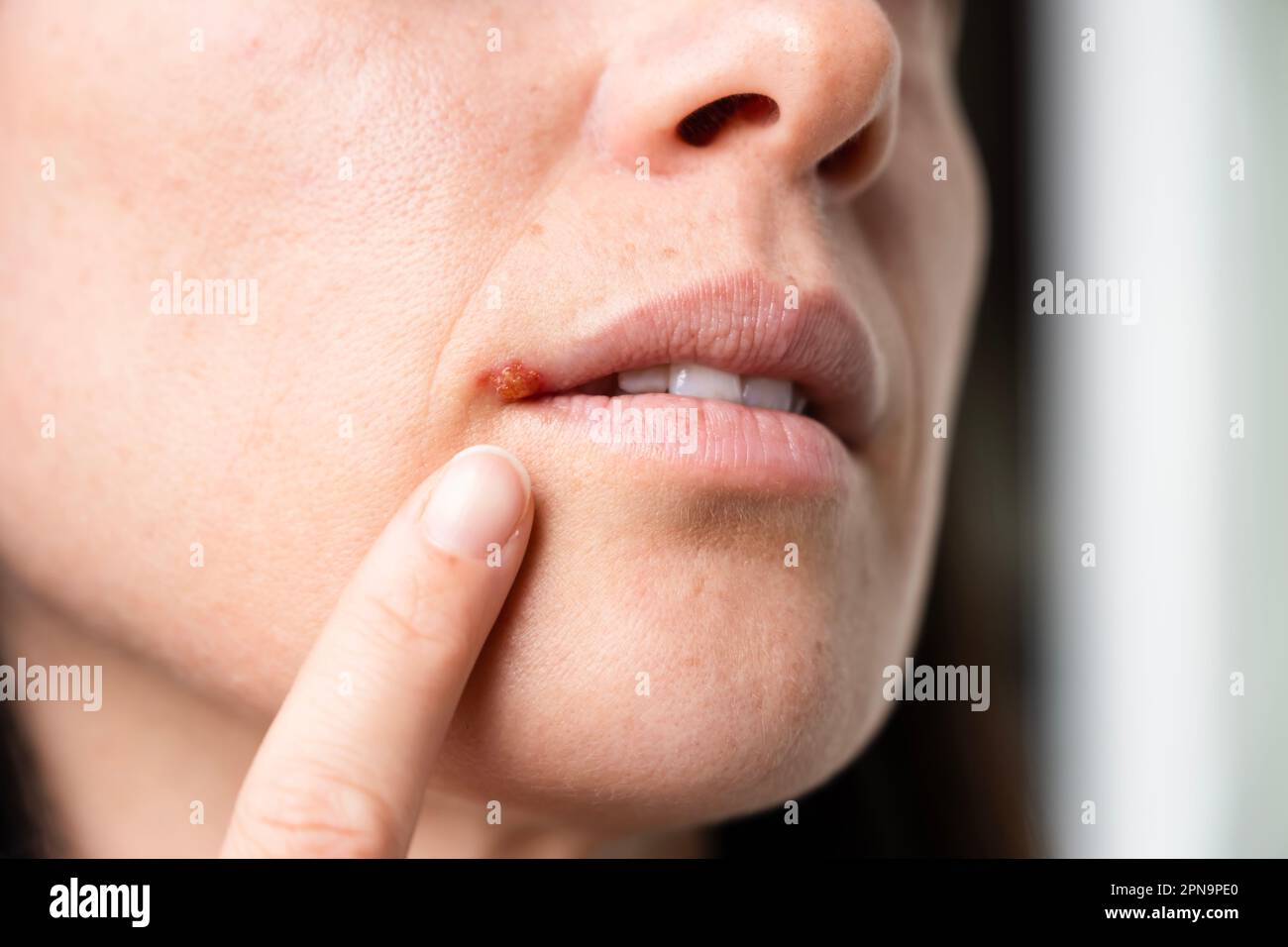 Infection de la peau cloques herpes Banque de photographies et d’images ...