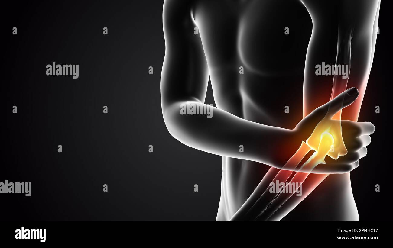 Inflamed tendon Banque de photographies et d’images à haute résolution ...