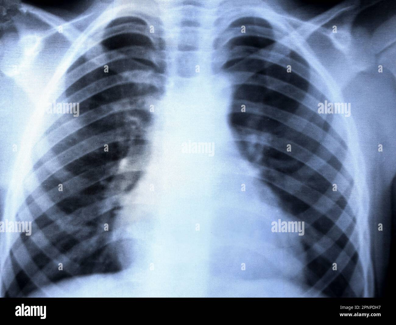 Radiographie thoracique en gros plan. Radiographie thoracique pour le ...