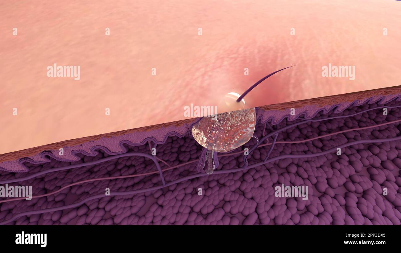 Pimple illustration Banque de photographies et d’images à haute ...