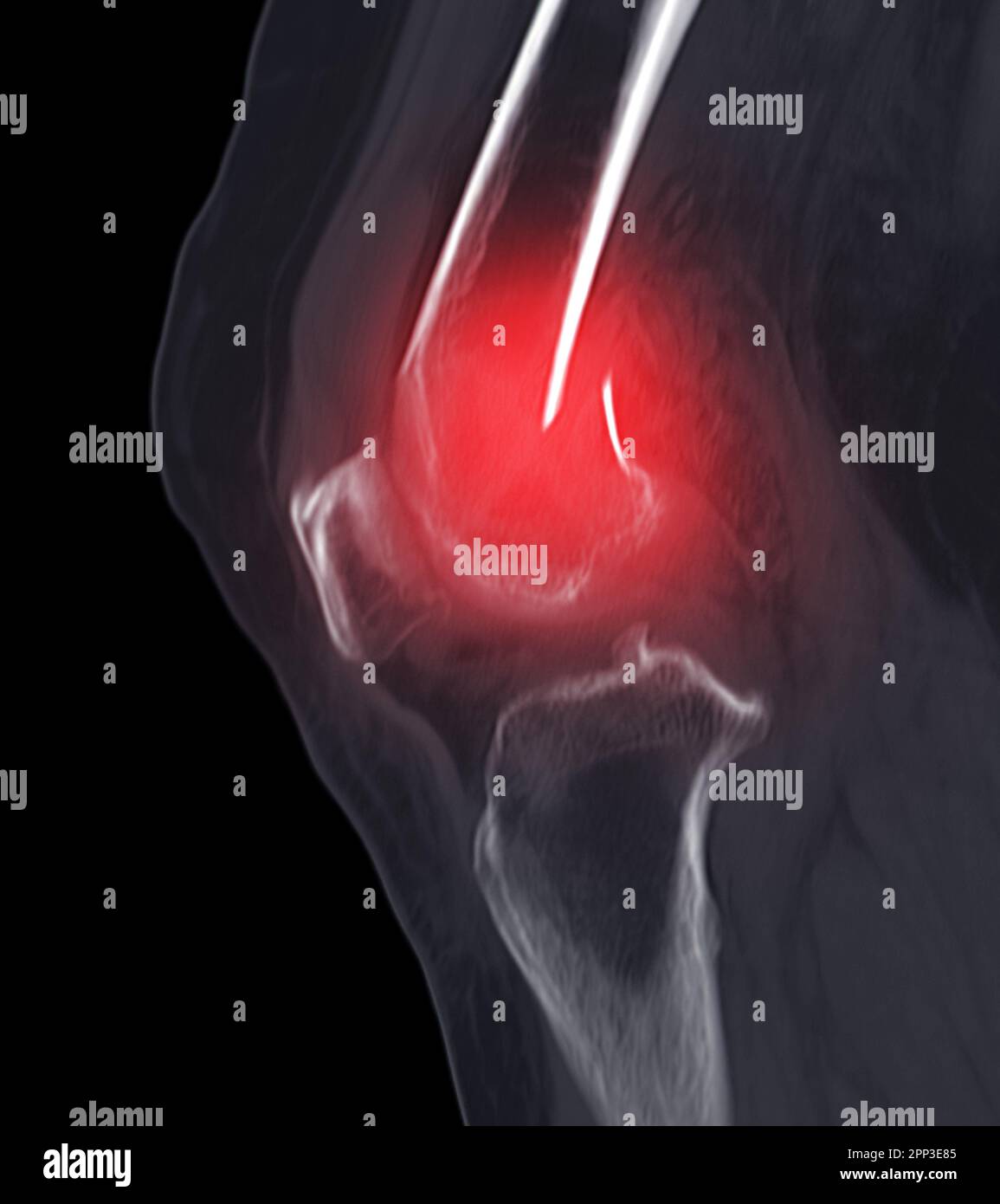 Acquisition CT de l'articulation du genou montrant une fracture de l'os ...