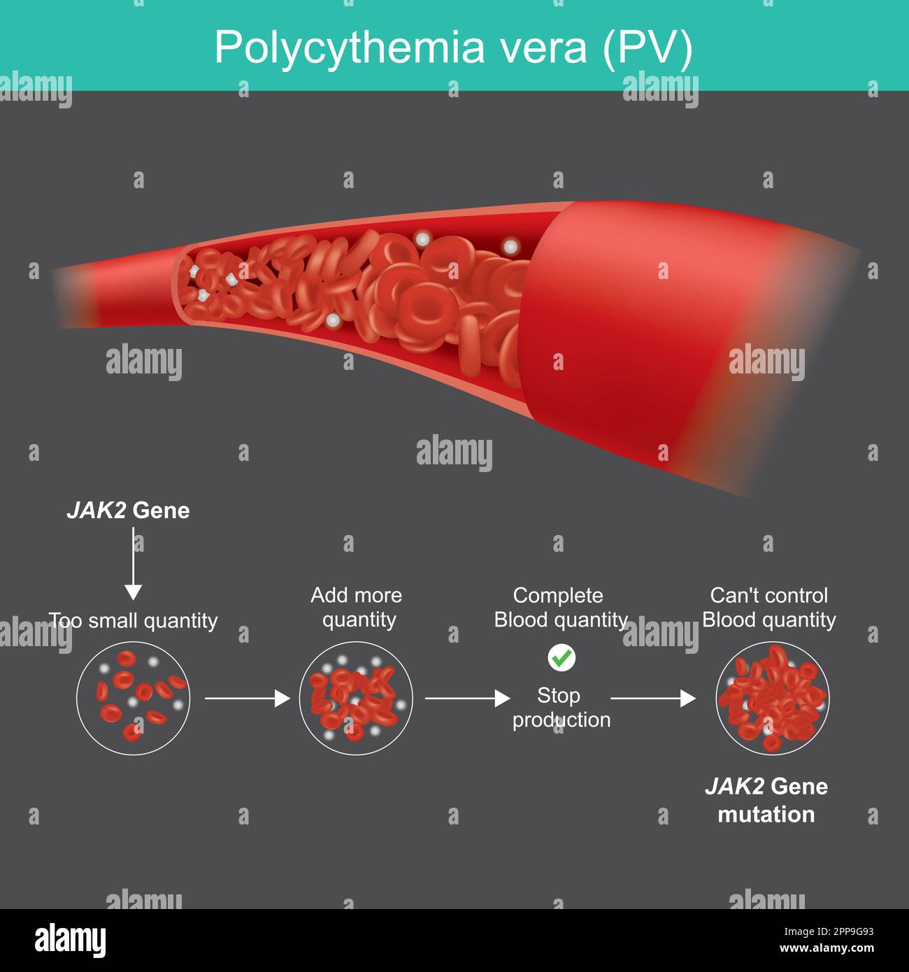 Polycythemia vera. Trop de globules rouges ont dans les vaisseaux ...