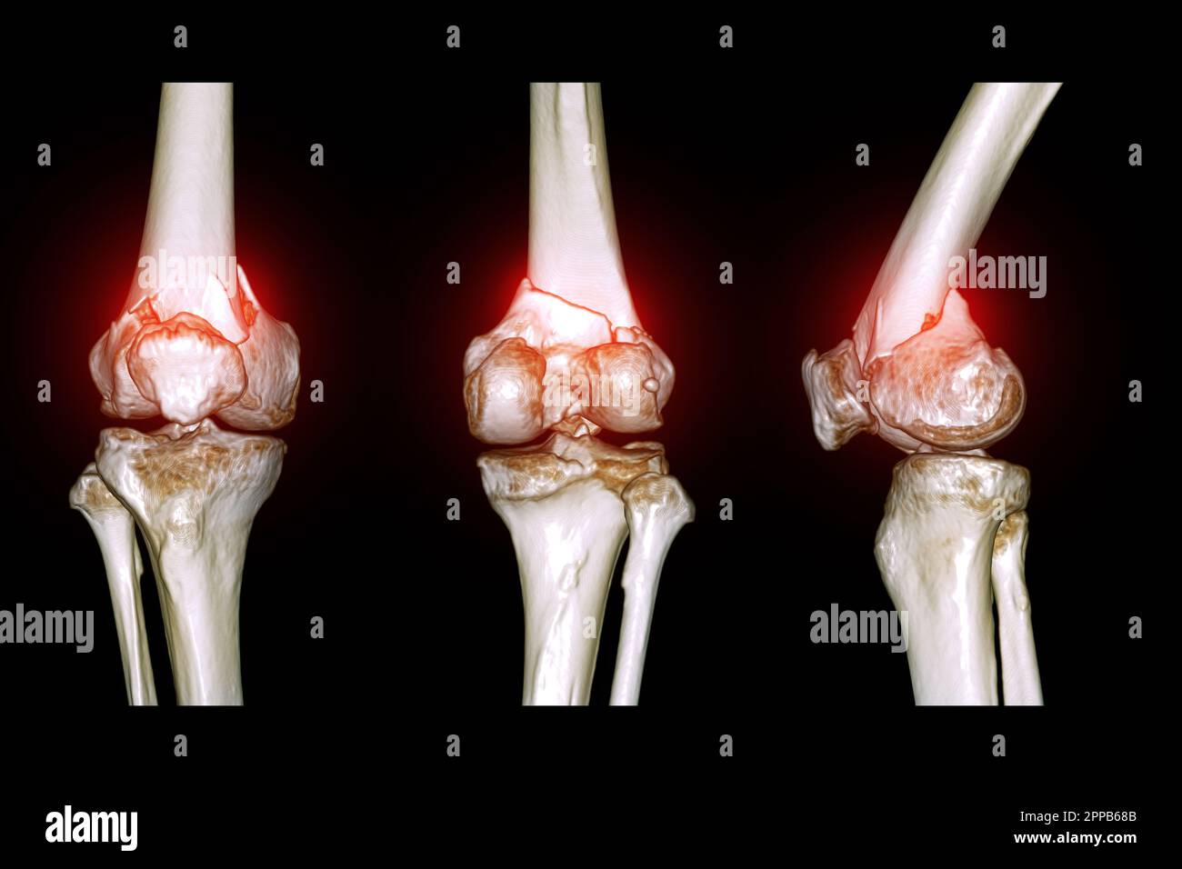 Acquisition CT de l'articulation du genou 3D image de rendu montrant ...