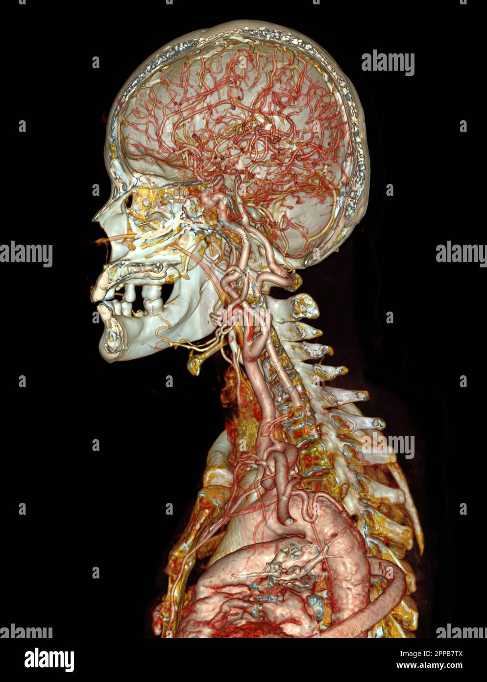 CTA cerveau et artère carotide ou angiographie CT du cerveau 3D rendu ...