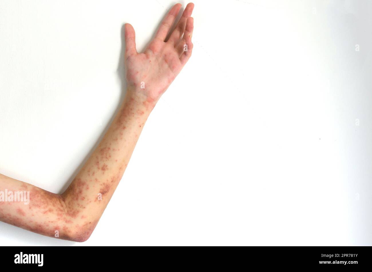 La dermatite atopique Banque de photographies et d’images à haute ...