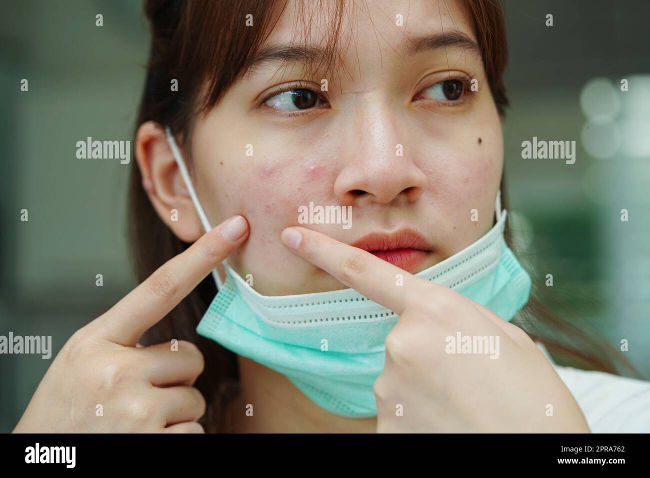 Acné bouton et cicatrice sur le visage de peau, troubles des glandes ...