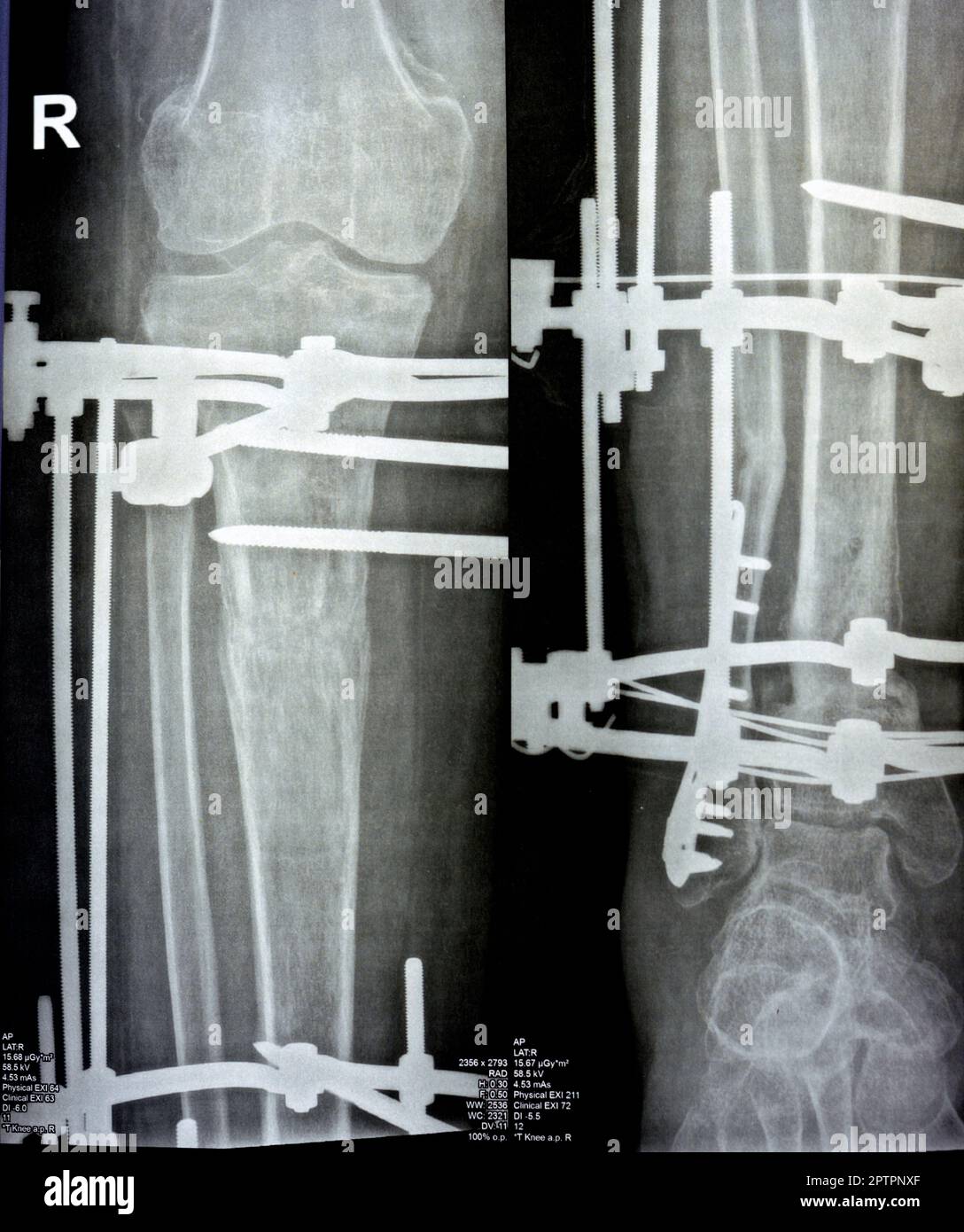 Péroné distal de fracture comminée géré par plaque et vis, tibia distal ...