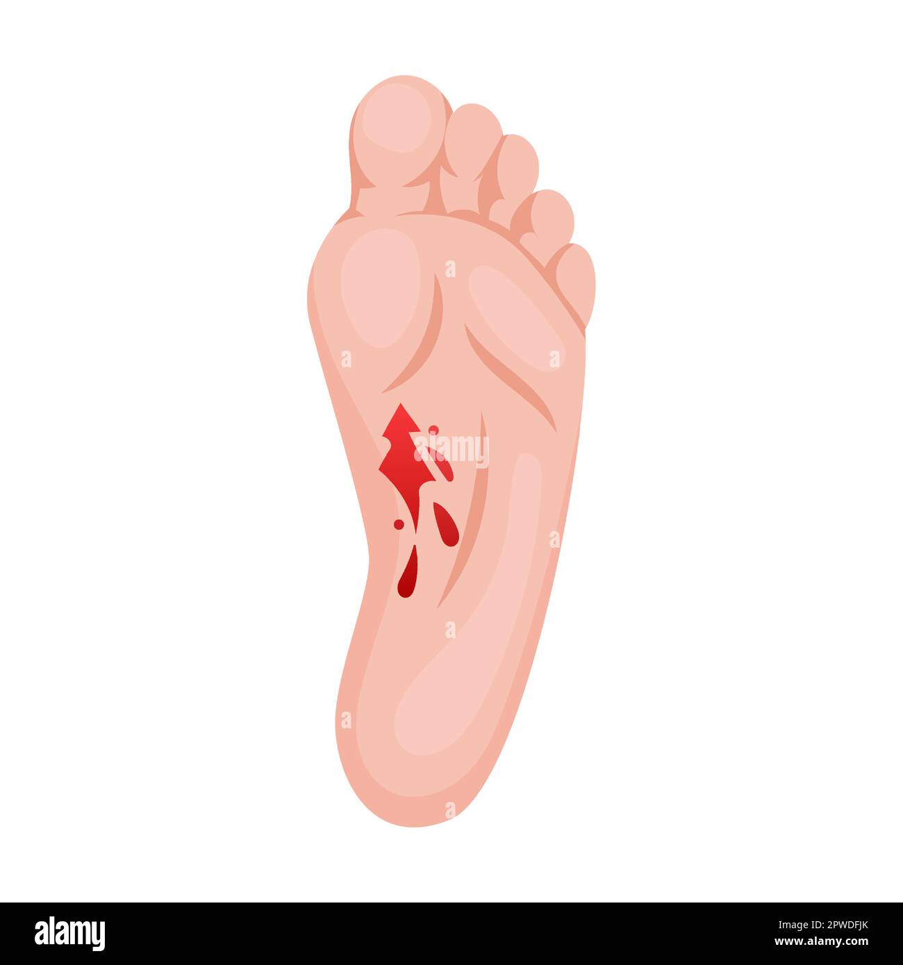 lacération ouverte sur le talon, partie inférieure du pied ...