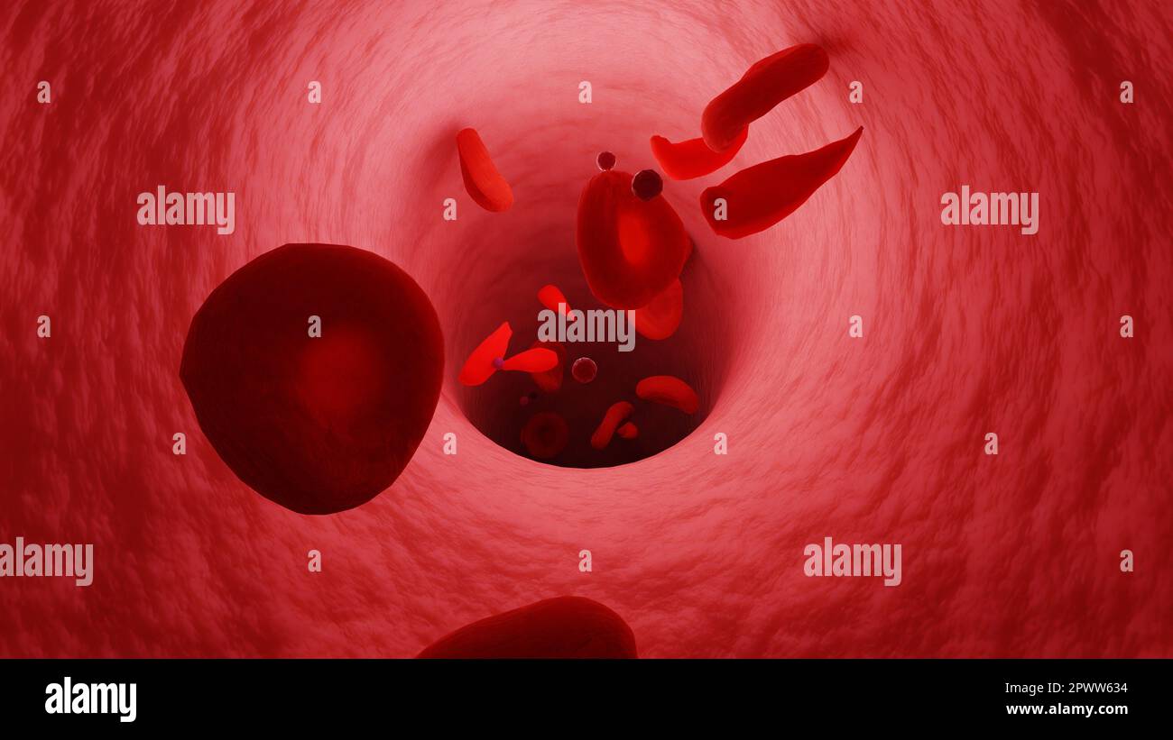 Tunnel veineux. Les cellules de faucille circulent dans la veine ...