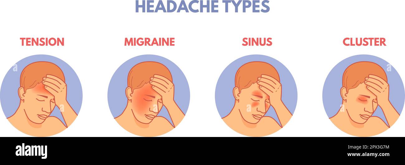 Types de maux de tête. Zones de migraines diagramme infographique ...
