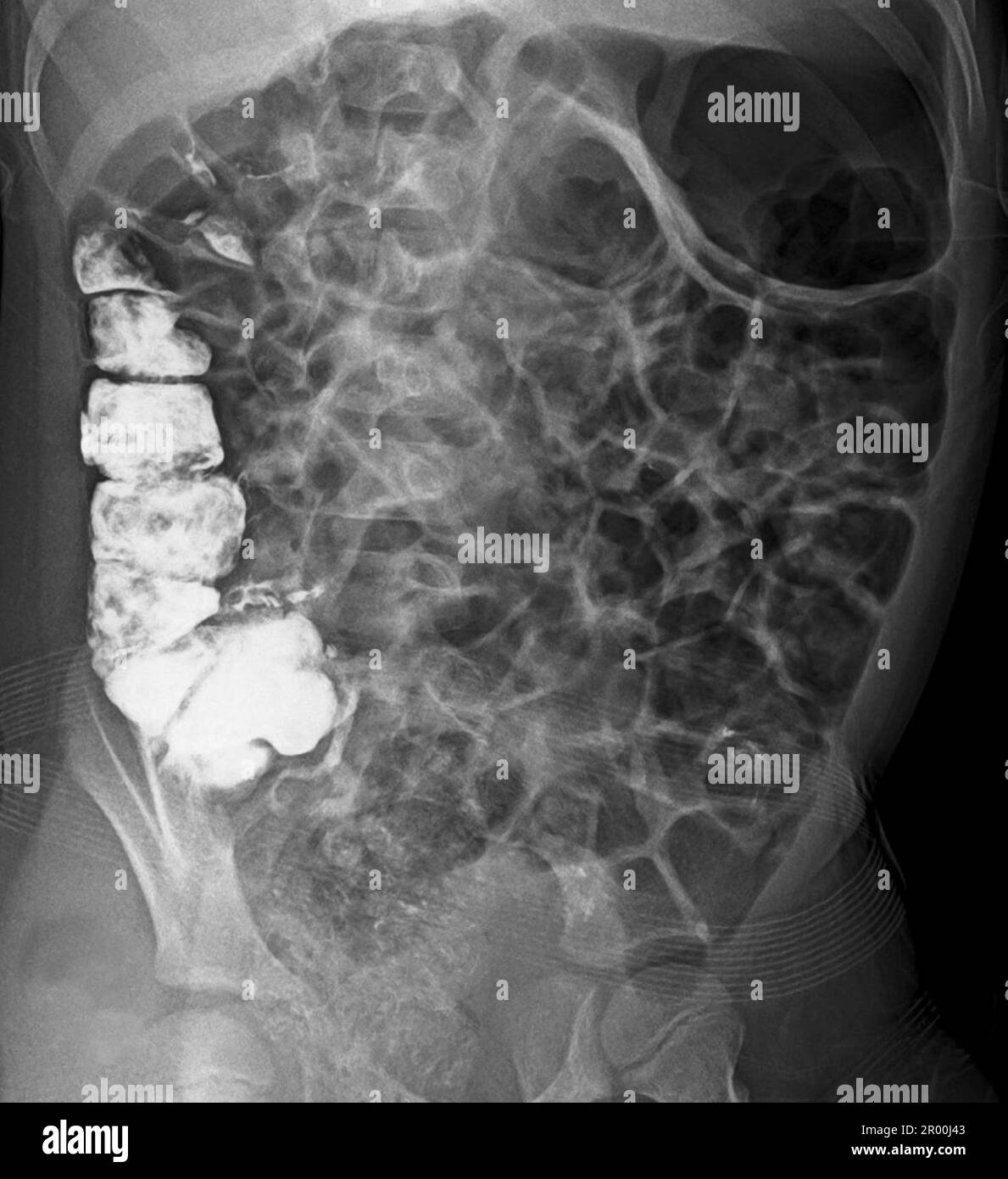 Barium xray Banque de photographies et d’images à haute résolution - Alamy