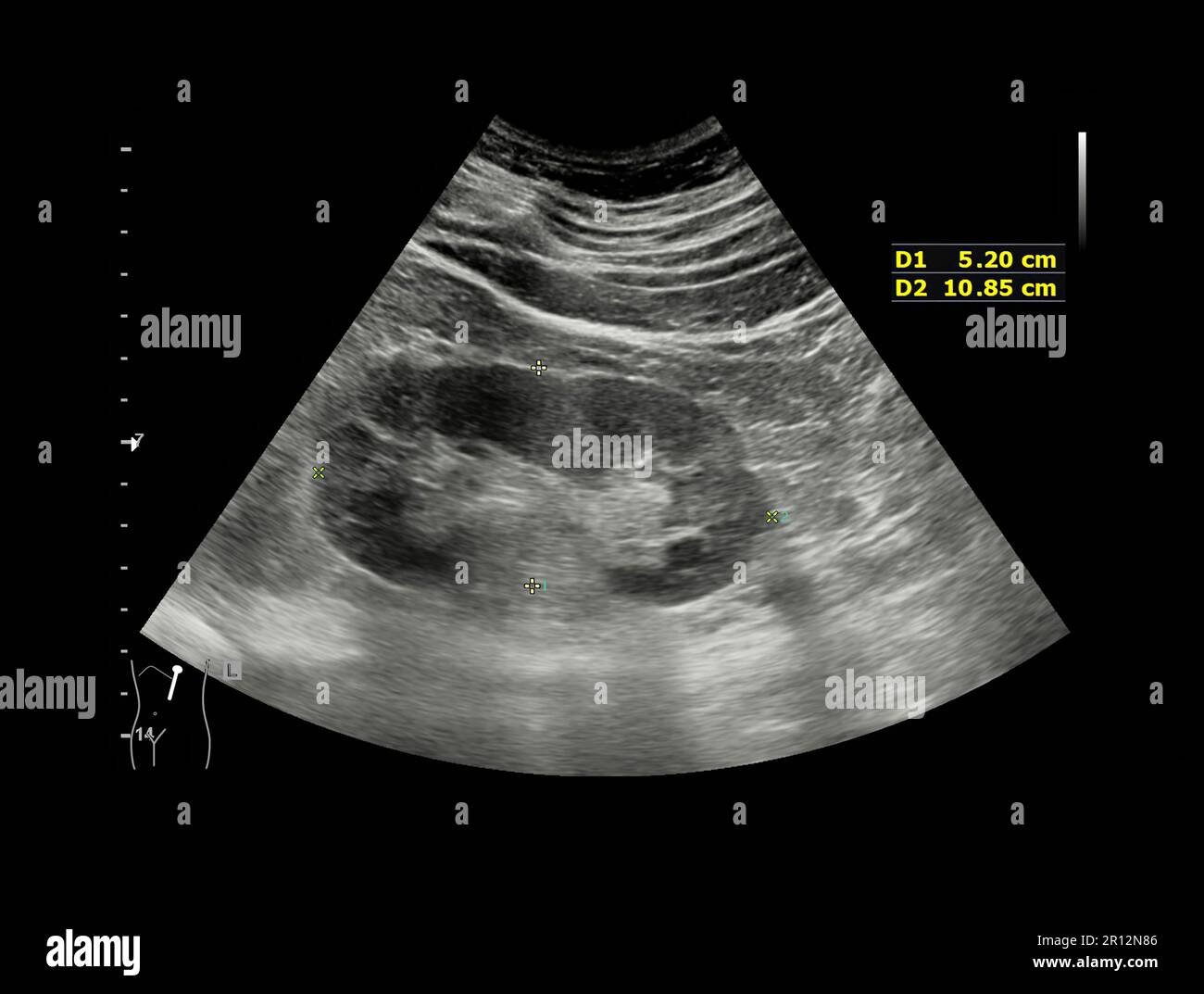 Échographie des reins ou KUB pour le dépistage de la maladie de la ...