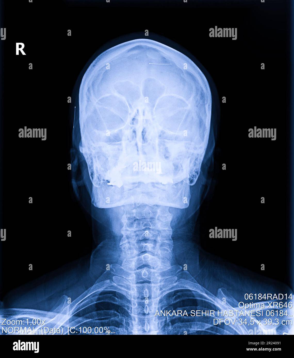 Radiographie du rachis cervical humain, radiographie du cou Photo Stock ...