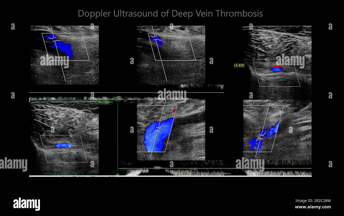 Détermination par échographie Doppler couleur chez les patients ...