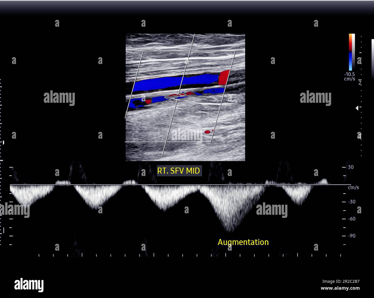 Détermination par échographie Doppler couleur chez les patients ...