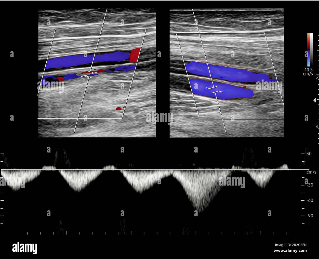 Détermination par échographie Doppler couleur chez les patients ...
