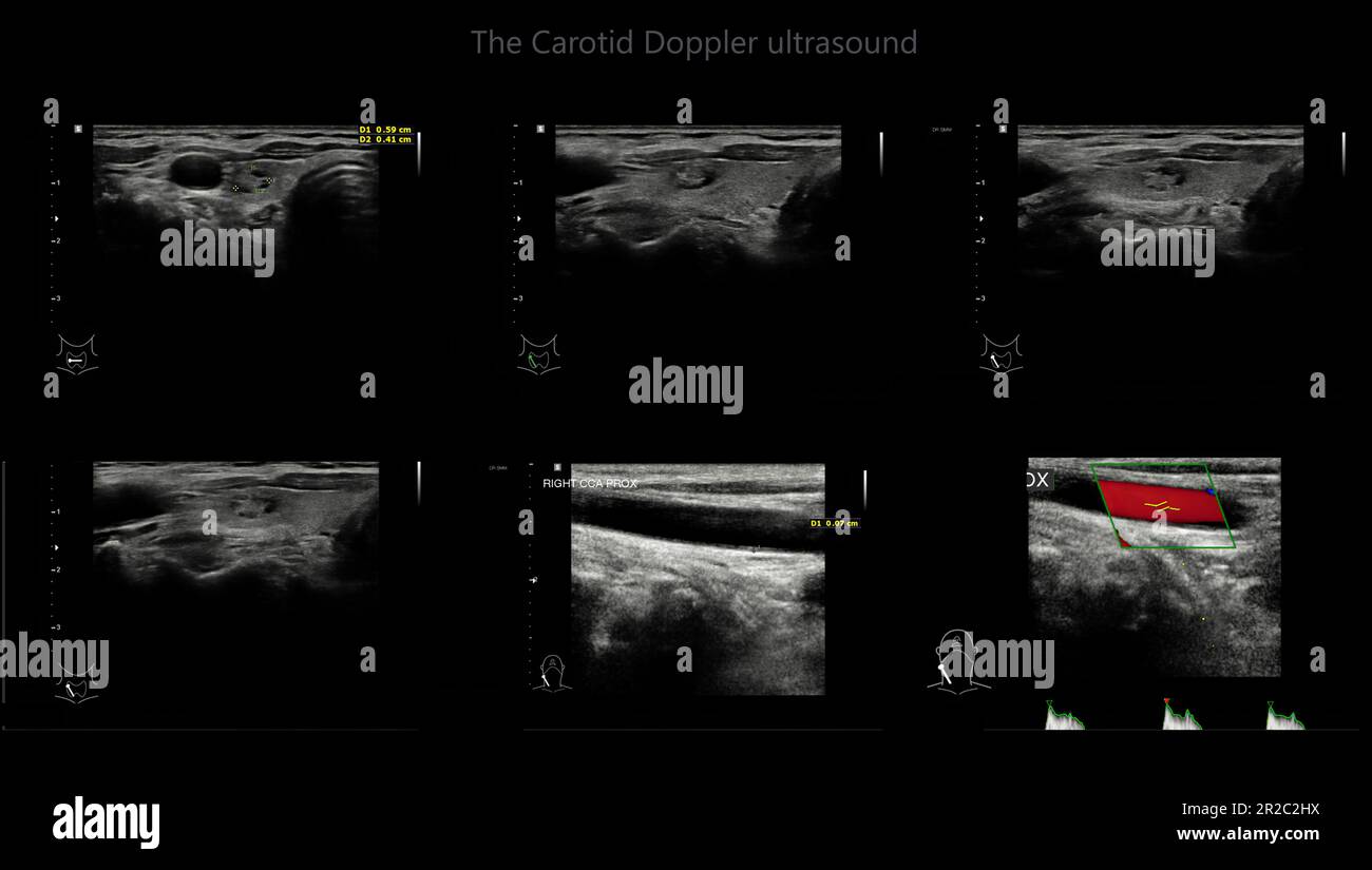 Une échographie Doppler de l'artère carotide est un test de diagnostic ...