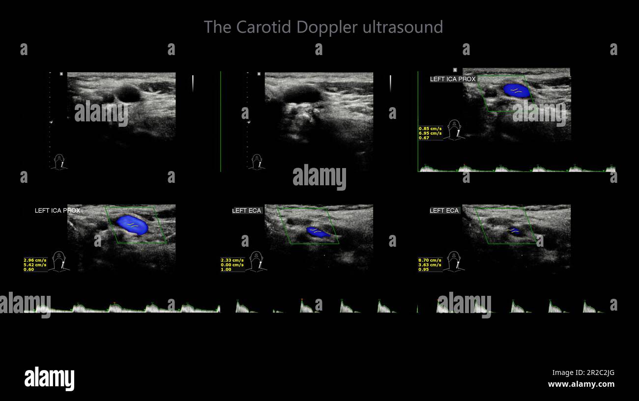 Une échographie Doppler de l'artère carotide est un test de diagnostic ...