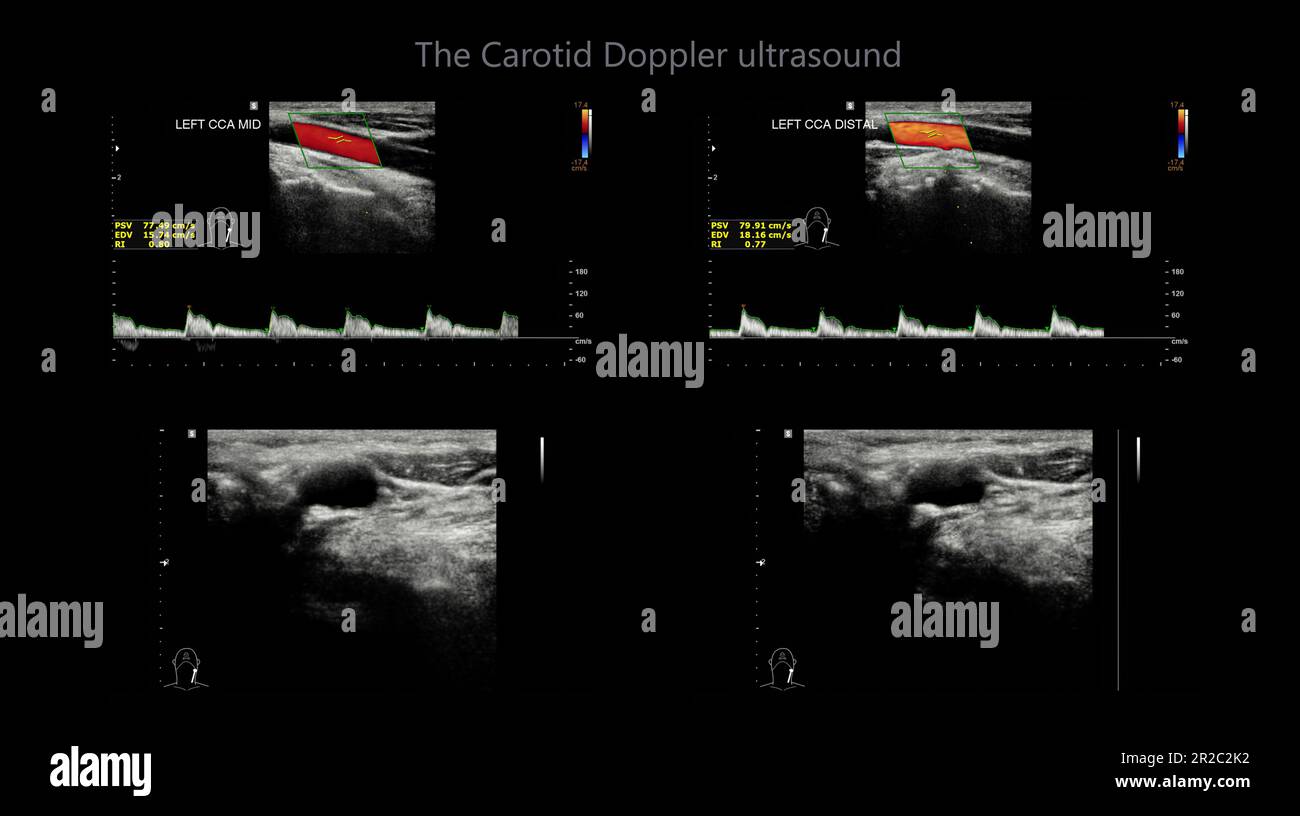 Une échographie Doppler de l'artère carotide est un test de diagnostic ...