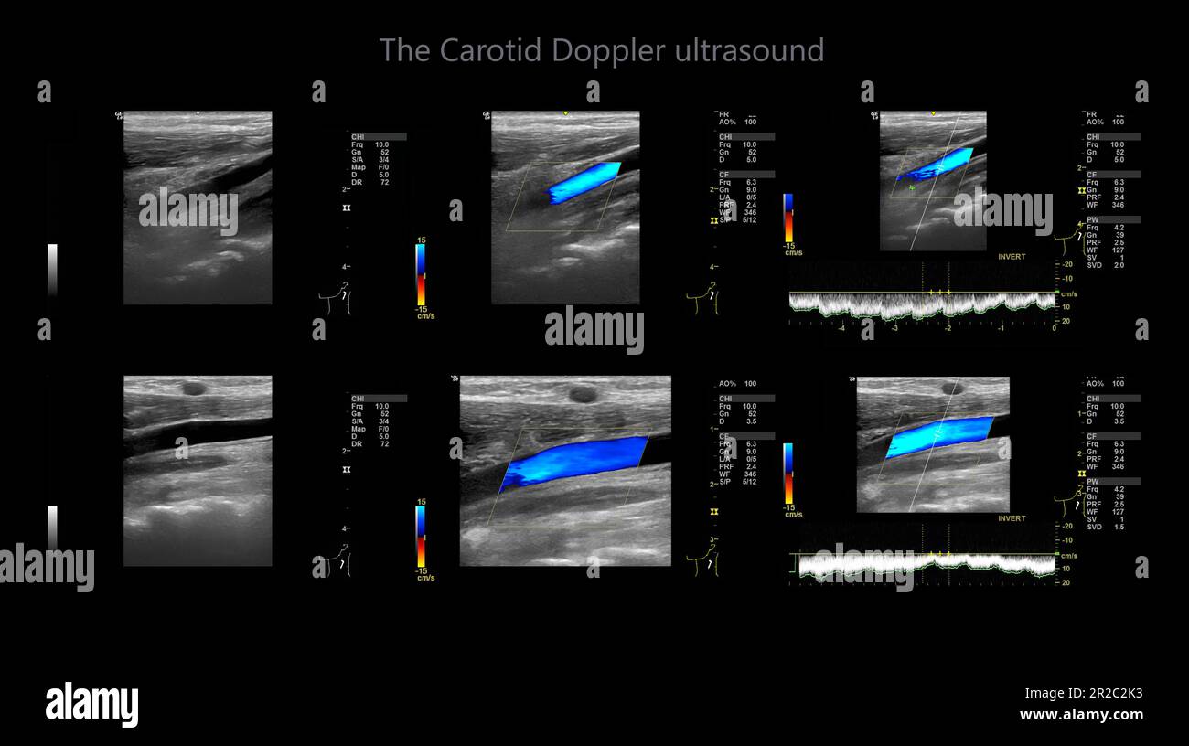 Une échographie Doppler de l'artère carotide est un test de diagnostic ...