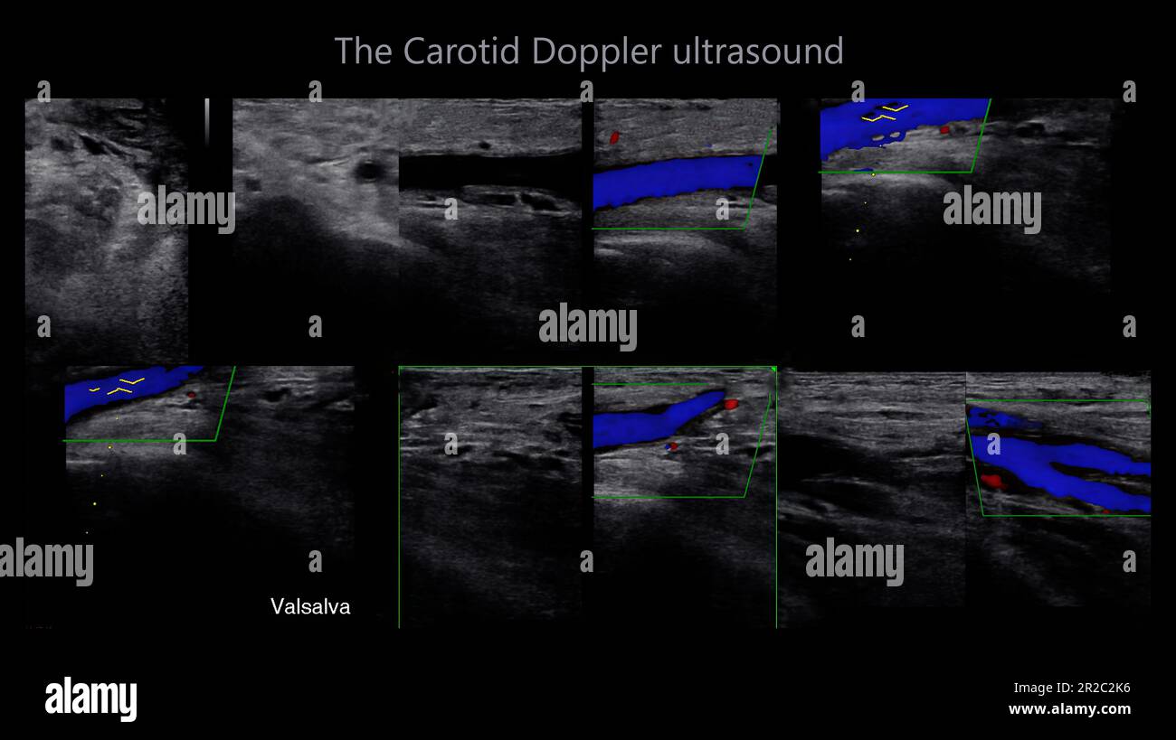 Une échographie Doppler de l'artère carotide est un test de diagnostic ...
