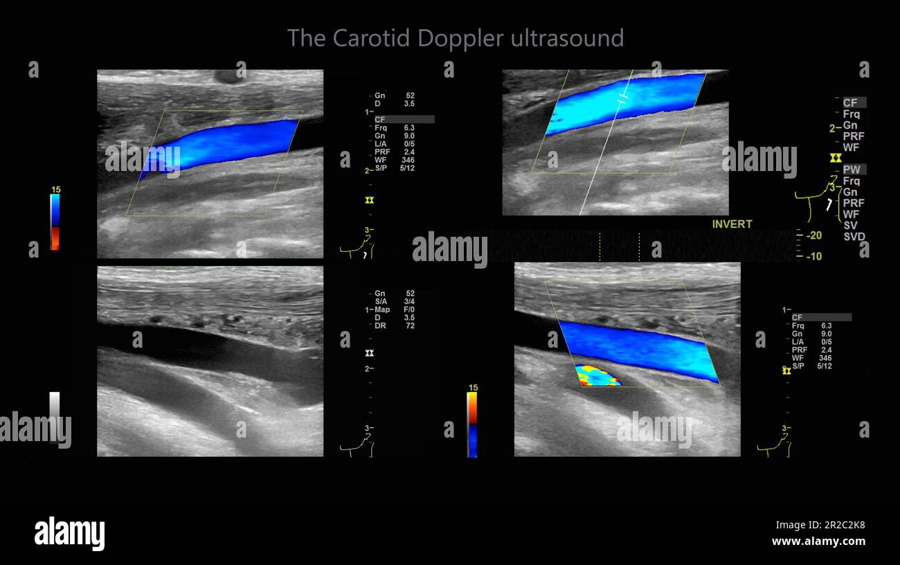 Une échographie Doppler de l'artère carotide est un test de diagnostic ...