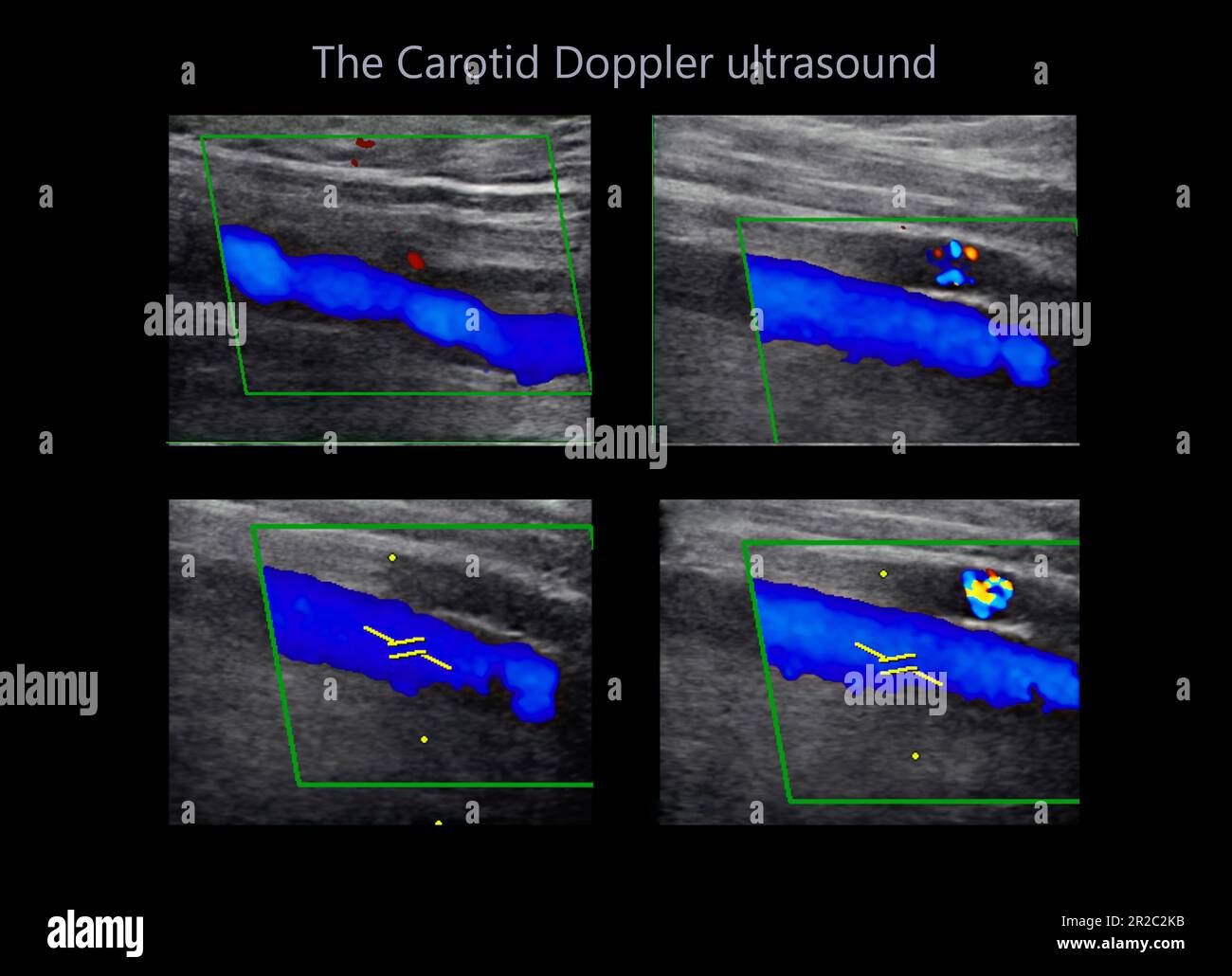 Une échographie Doppler de l'artère carotide est un test de diagnostic ...