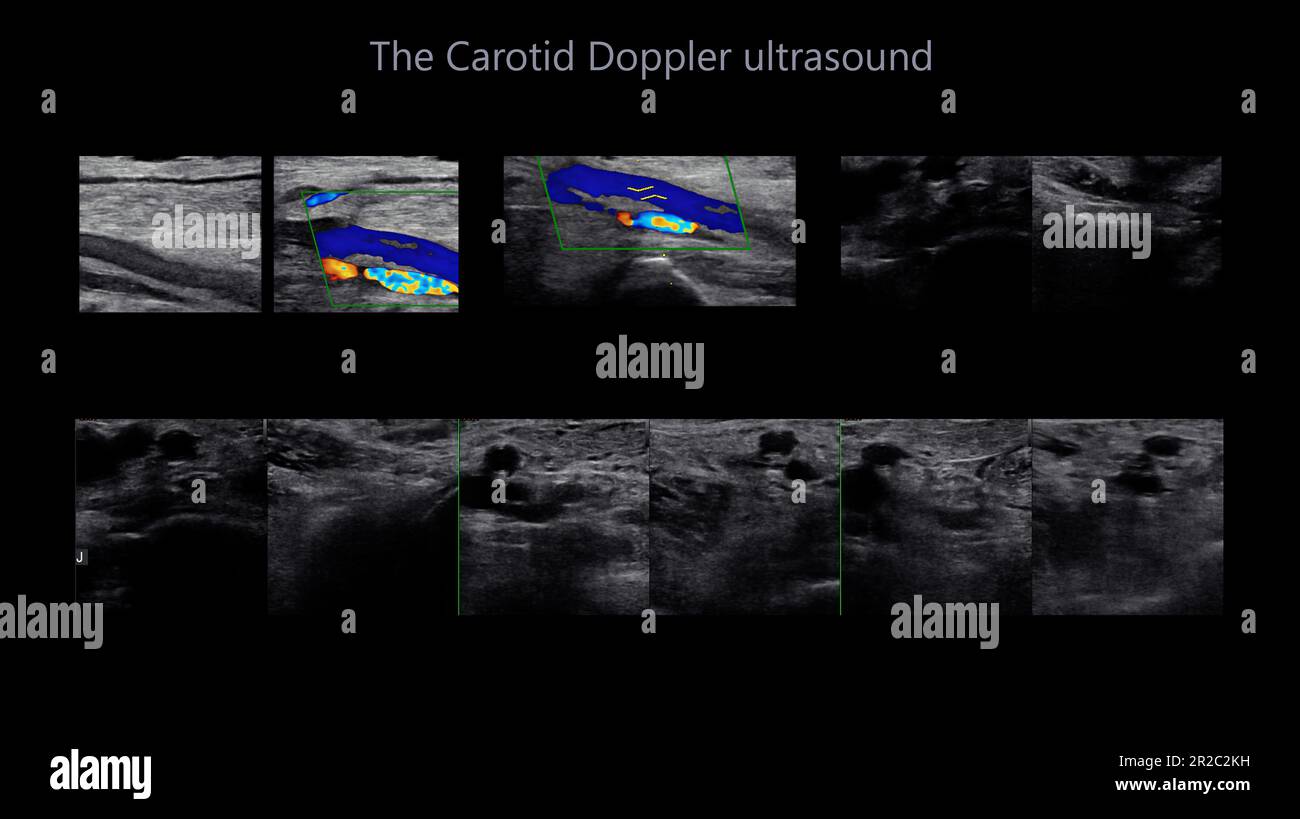 Une échographie Doppler de l'artère carotide est un test de diagnostic ...