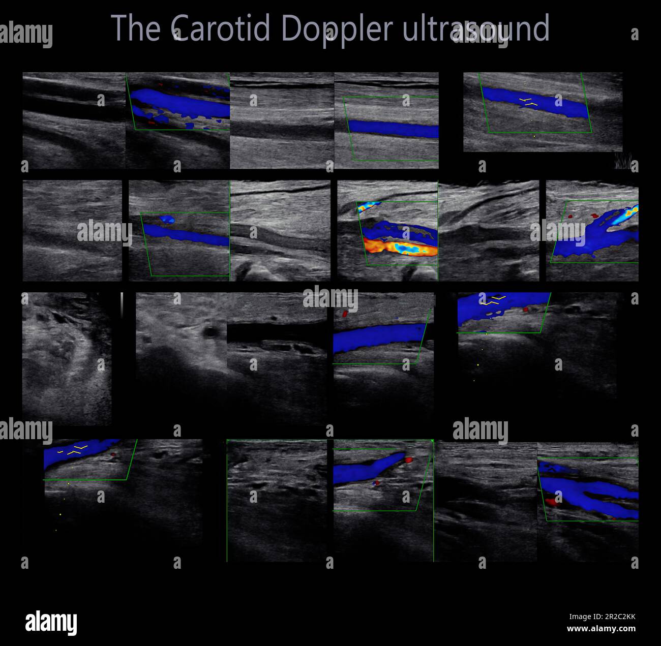 Une échographie Doppler de l'artère carotide est un test de diagnostic ...