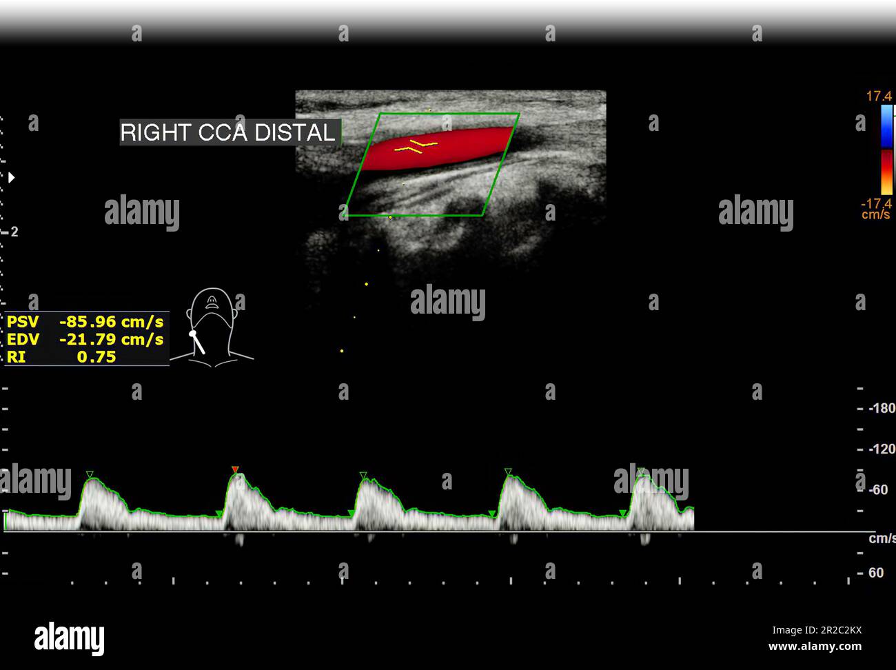 Une échographie Doppler de l'artère carotide est un test de diagnostic ...