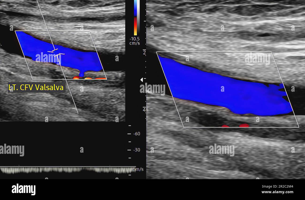 Une échographie Doppler de l'artère carotide est un test de diagnostic ...
