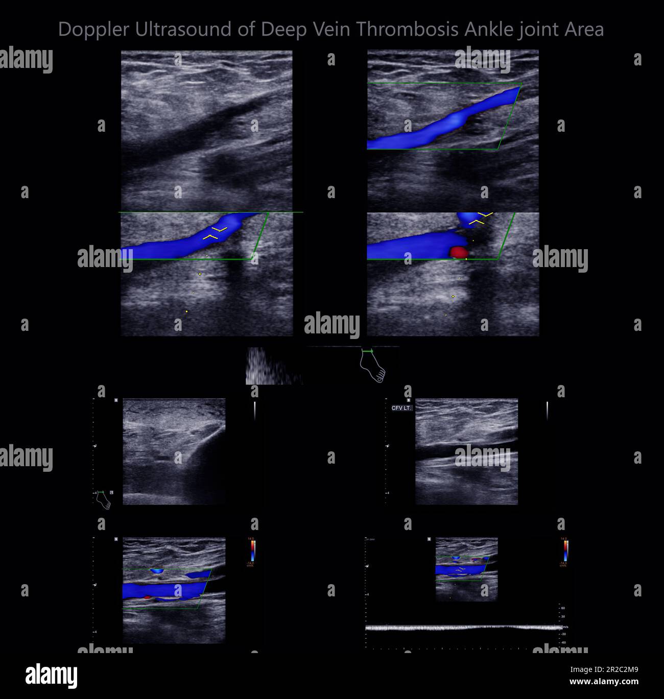 Détermination par échographie Doppler couleur chez les patients ...