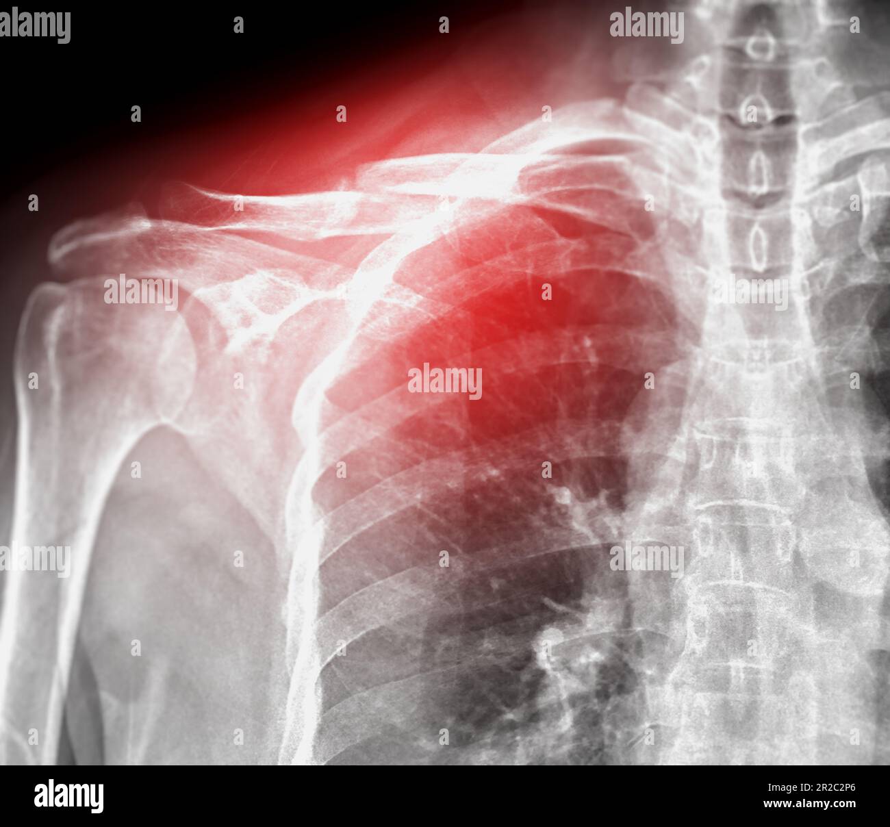 Fractura de clavicula paciente Banque de photographies et d’images à ...