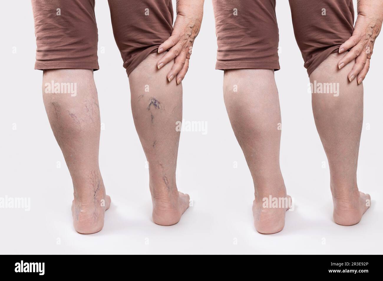 Varicosité. Gros plan des jambes de la femme avec des astérisques ...