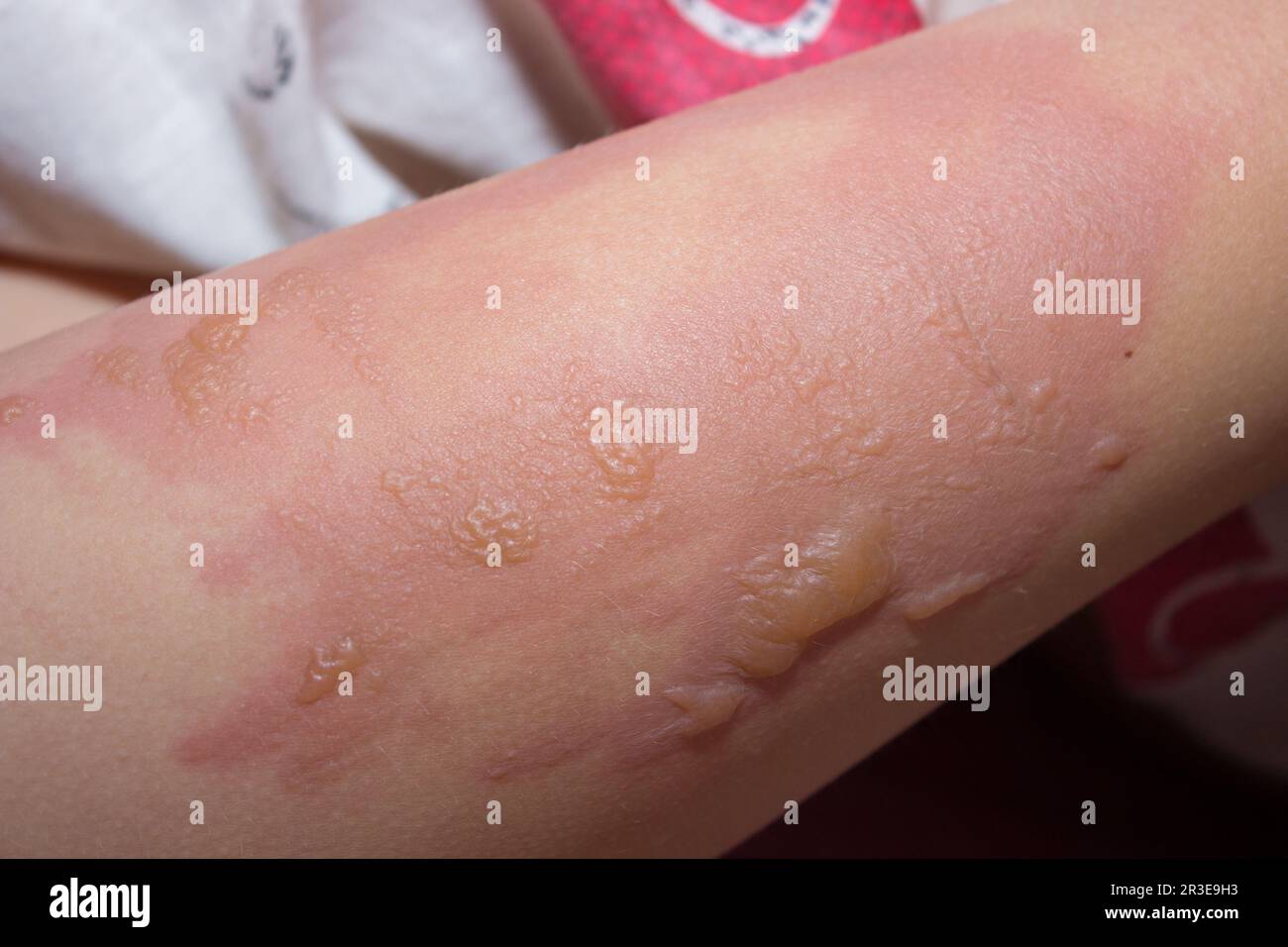 éruptions cutanées aux jambes Banque de photographies et d’images à ...