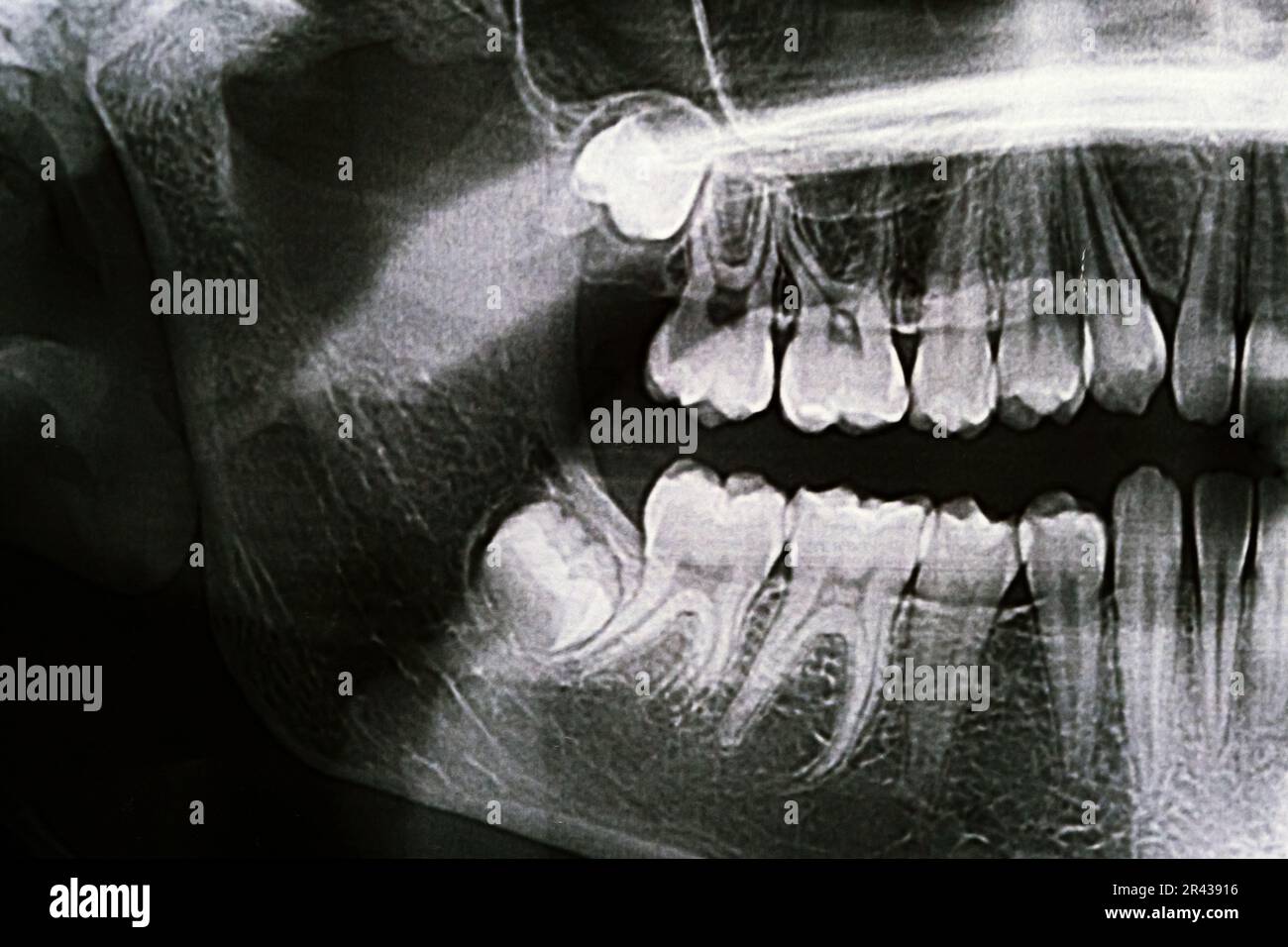 Radiographie panoramique de la mâchoire. Radiographie des dents d'une ...