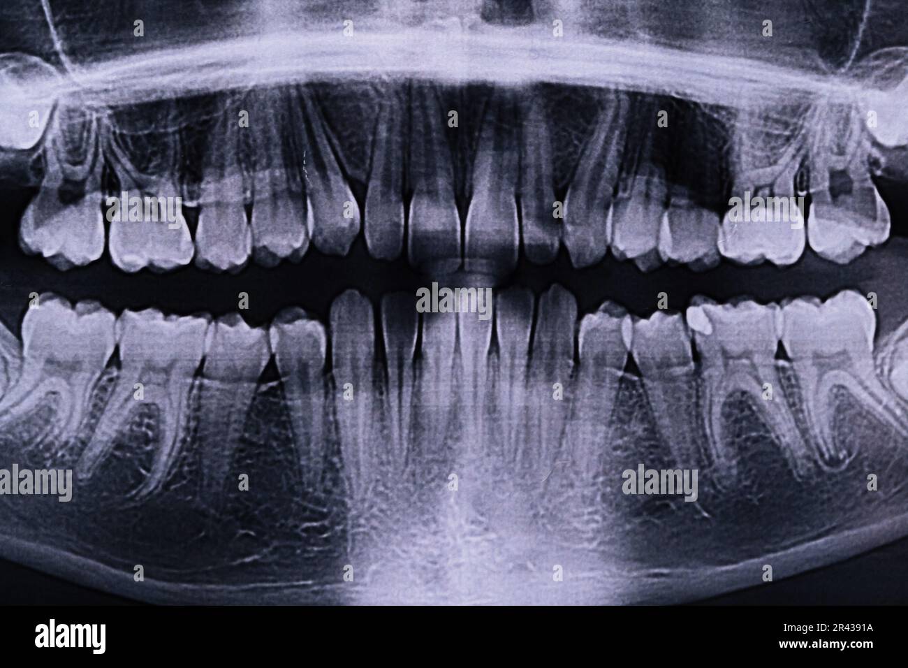 Radiographie panoramique de la mâchoire. Radiographie des dents d'une ...