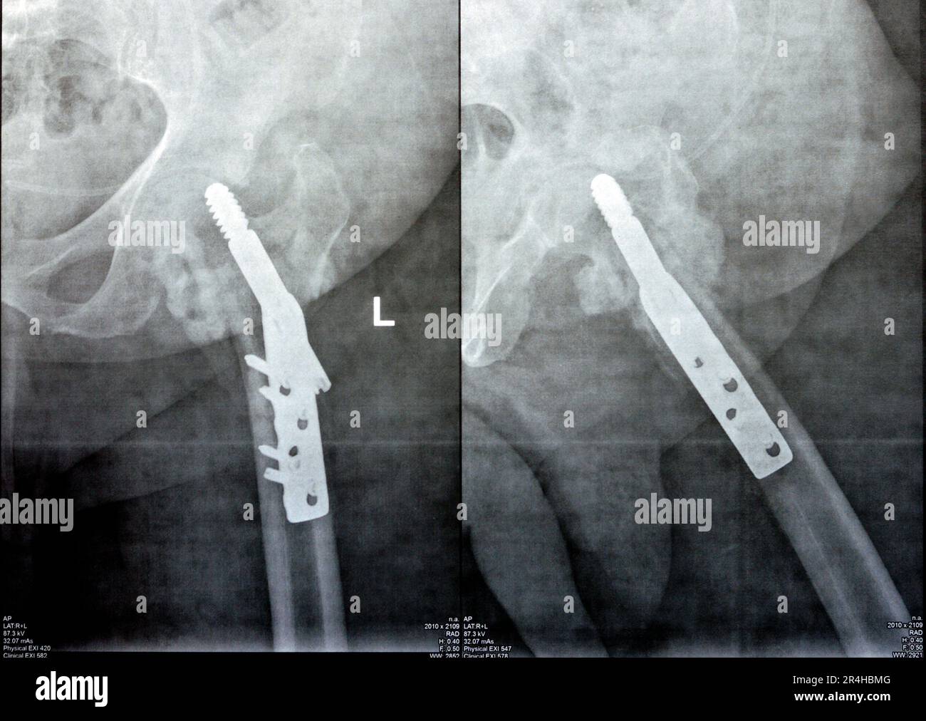 Col cervical trans de la hanche gauche de la fracture du fémur fixé par ...